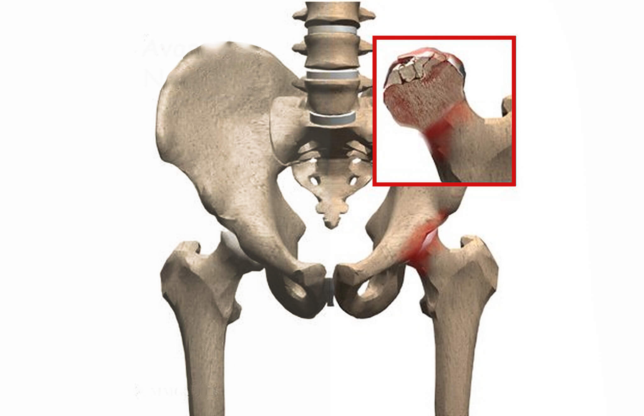 Best Hip Replacement Doctor in Raipur | Dr. Saurabh Khare