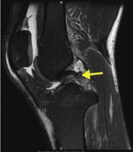Best Knee PCL Injury treatment in Raipur | Dr. Saurabh Khare